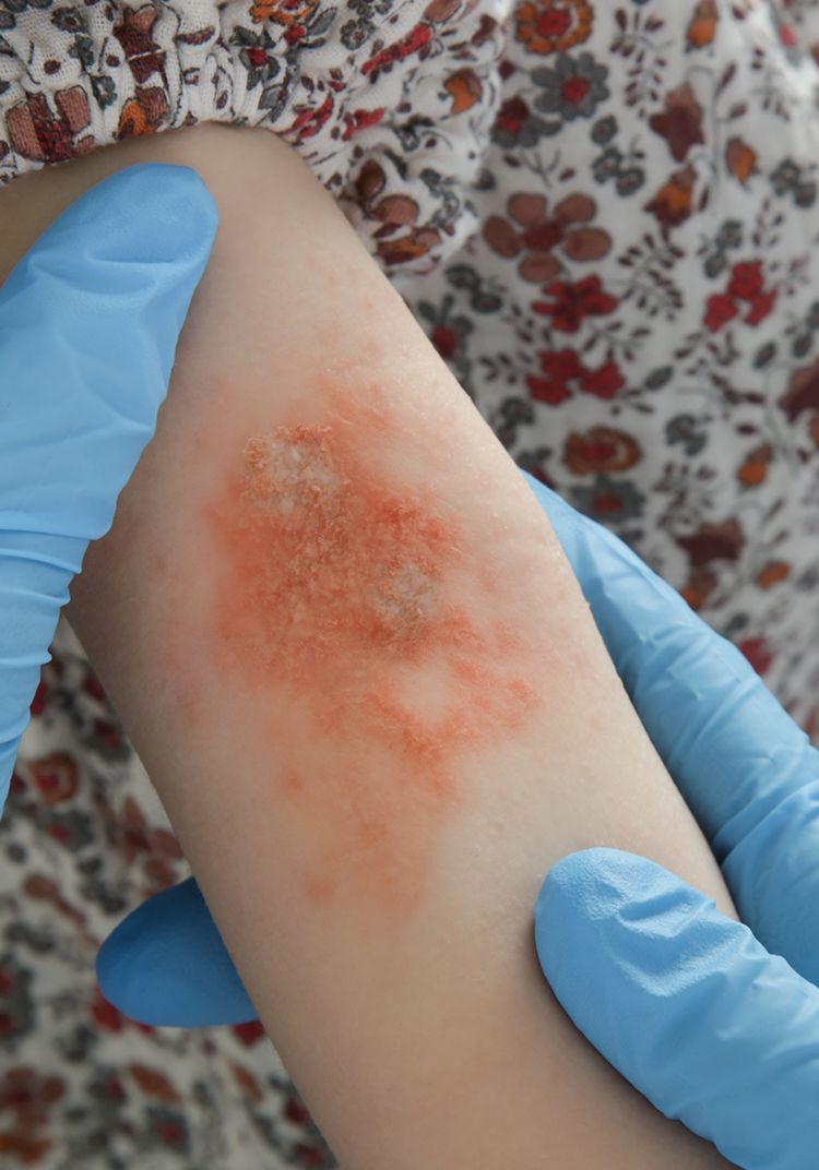 A Caregivers Guide for Pediatric Psoriasis